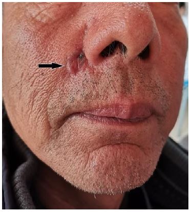 Clinical Manifestations and Therapeutic Observation of 123 Cases of ...